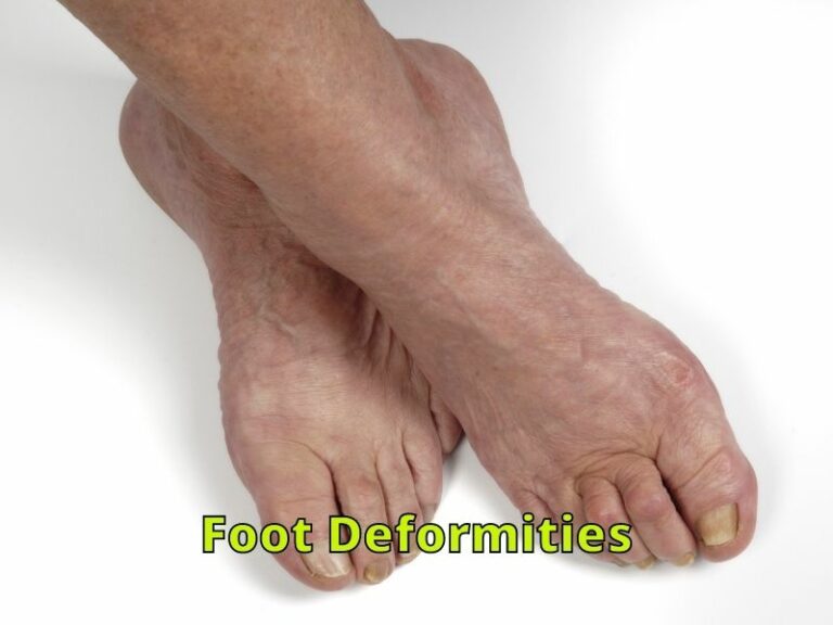 Why Do I have Wide Feet? – Help Shoe